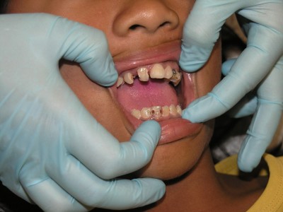 Top 10 Countries With the Worst Teeth, Oral Health and Hygiene in the ...